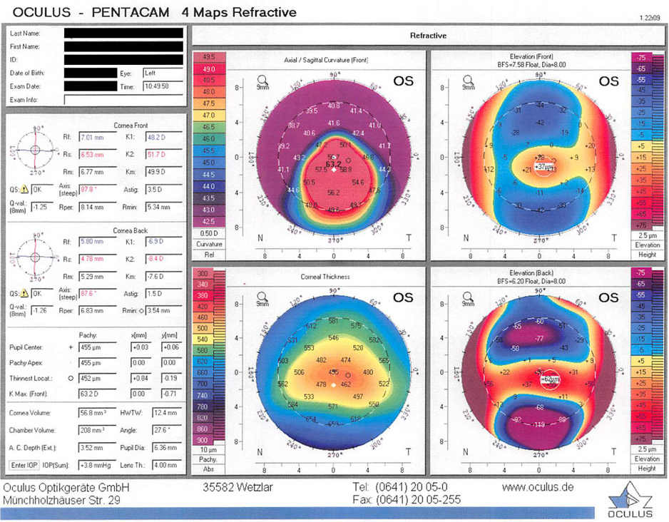 Keratoconus screening in the U.S. - EyeWorld