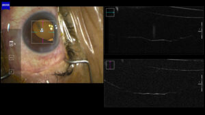Anterior segment OCT for cataract surgery: preop, intraop, and postop ...