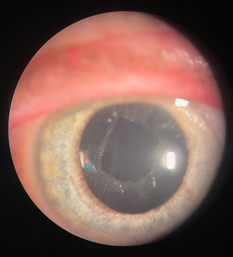 Posterior capsulotomy: history of using the YAG laser and best ...
