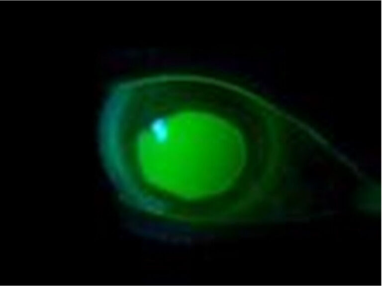 Addressing neurotrophic keratitis - EyeWorld