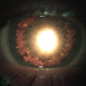 Pigment dispersion syndrome and pigmentary glaucoma: the basics - EyeWorld