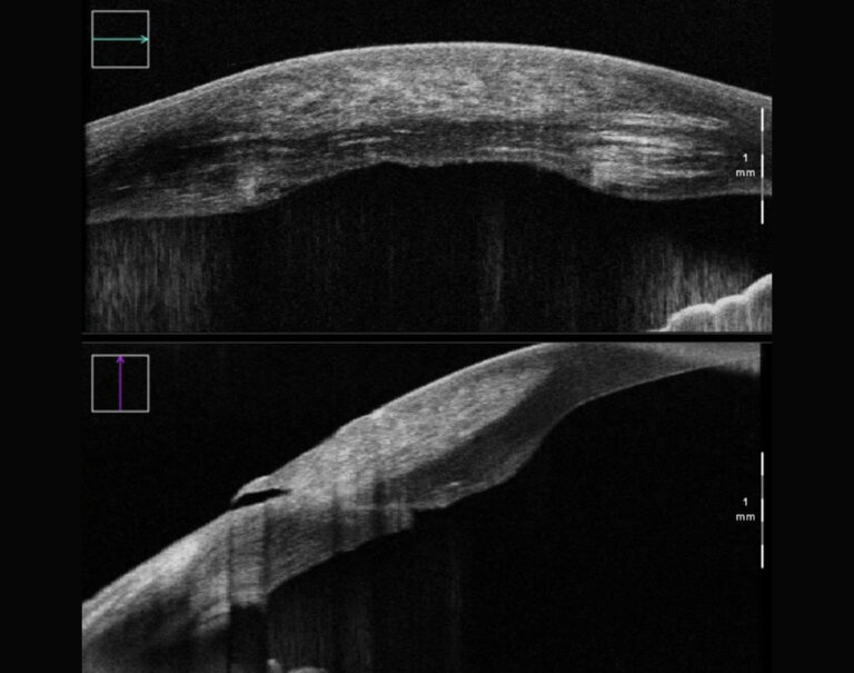 Incisions in cataract surgery - EyeWorld